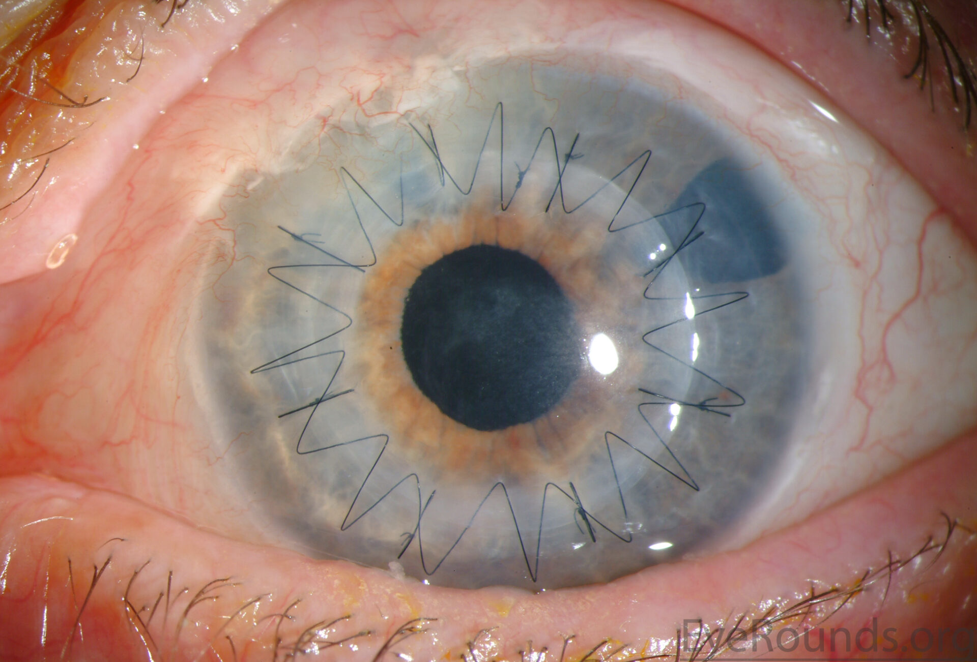 Does Photo-Refractive Keratectomy Remove Cornea? | VZ Collective
